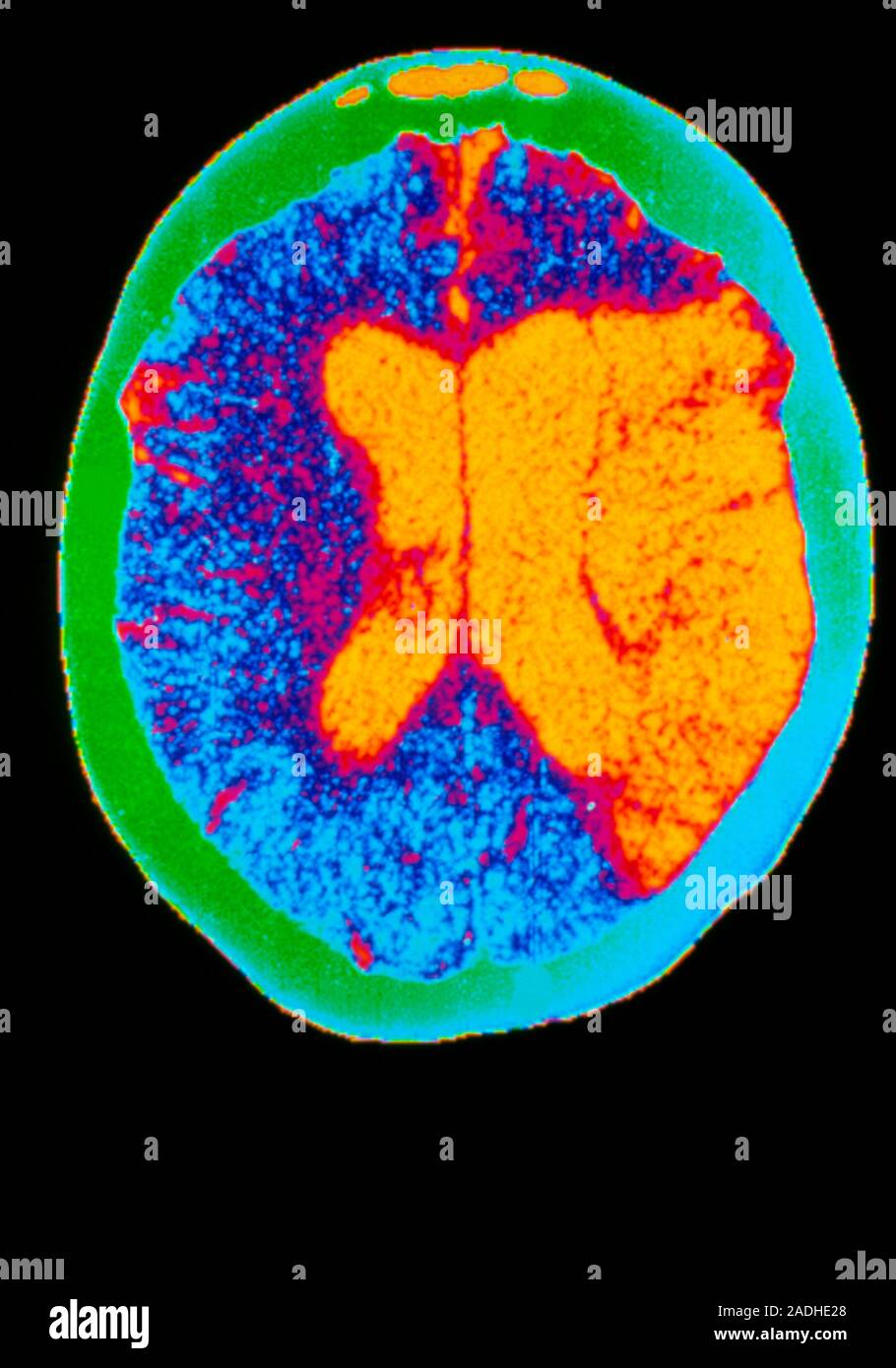 Brain haemorrhage. Coloured computed tomography (CT) scan of the brain seen in axial section ...