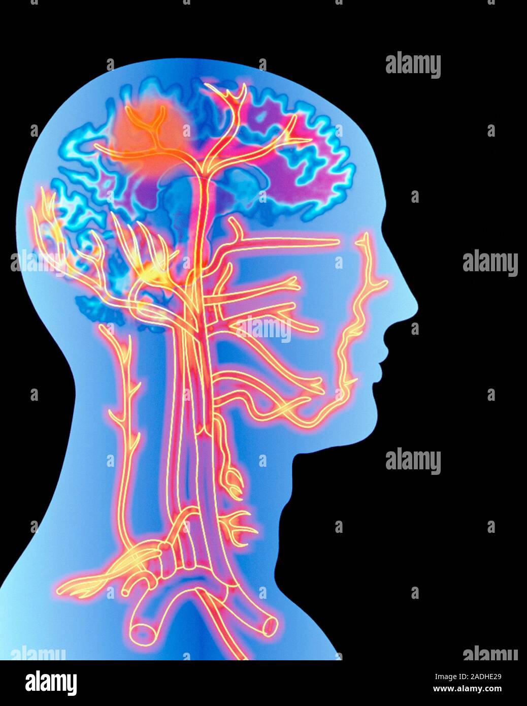 Brain haemorrhage. Computer artwork of the blood vessels in the human ...