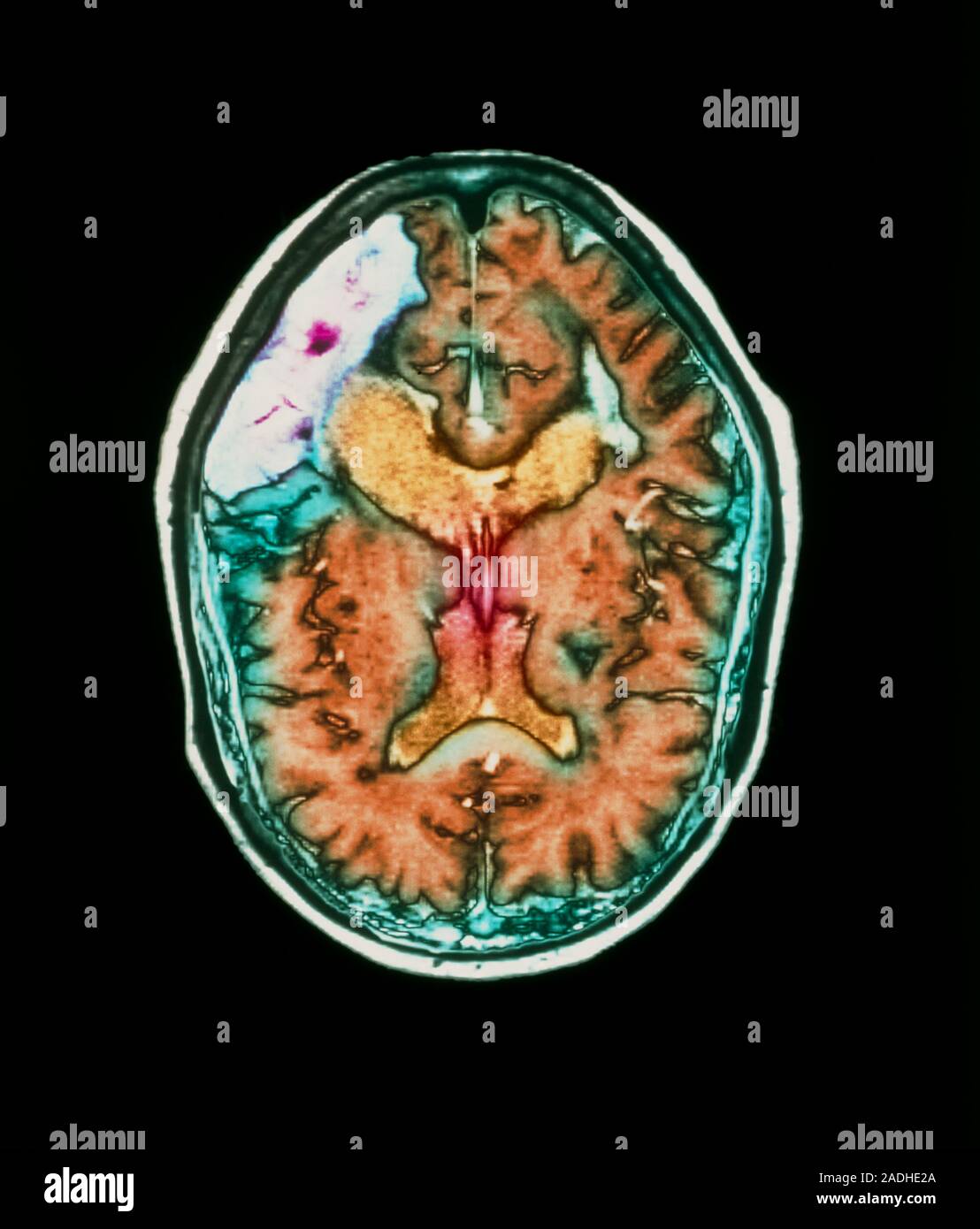 Stroke. Coloured magnetic resonance imaging (MRI) scan of an axial section through the brain of ...