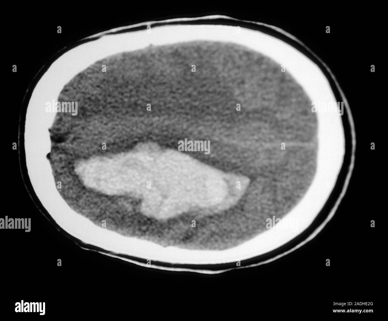 Stroke. Computed tomography (CT) scan of the brain seen in axial ...
