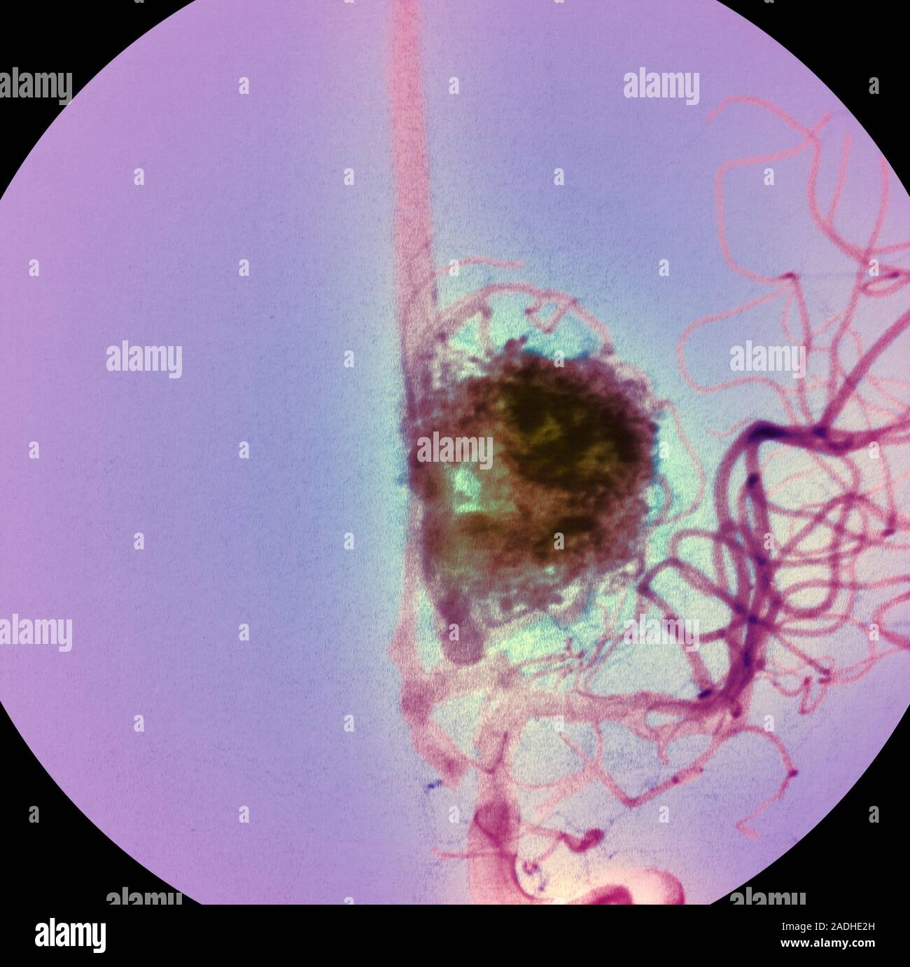 Blood vessel tumour. Coloured angiogram (X-ray) of an arteriovenous ...