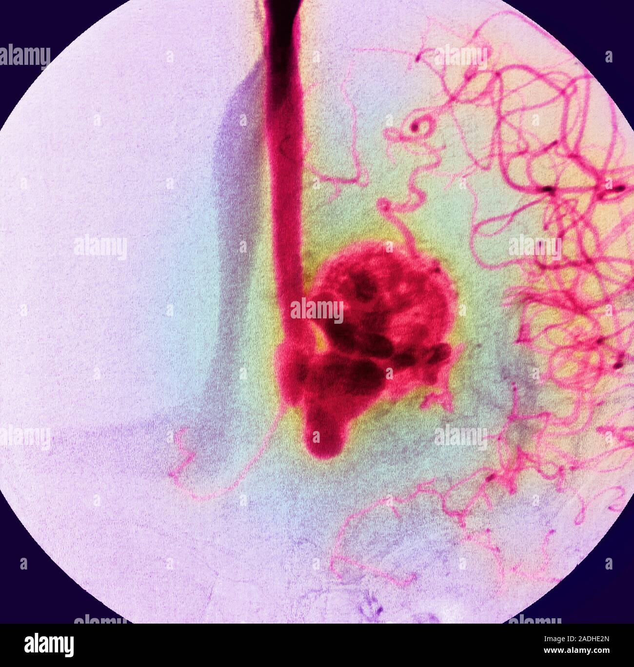 Blood vessel tumour. Coloured angiogram (X-ray) of an arteriovenous ...