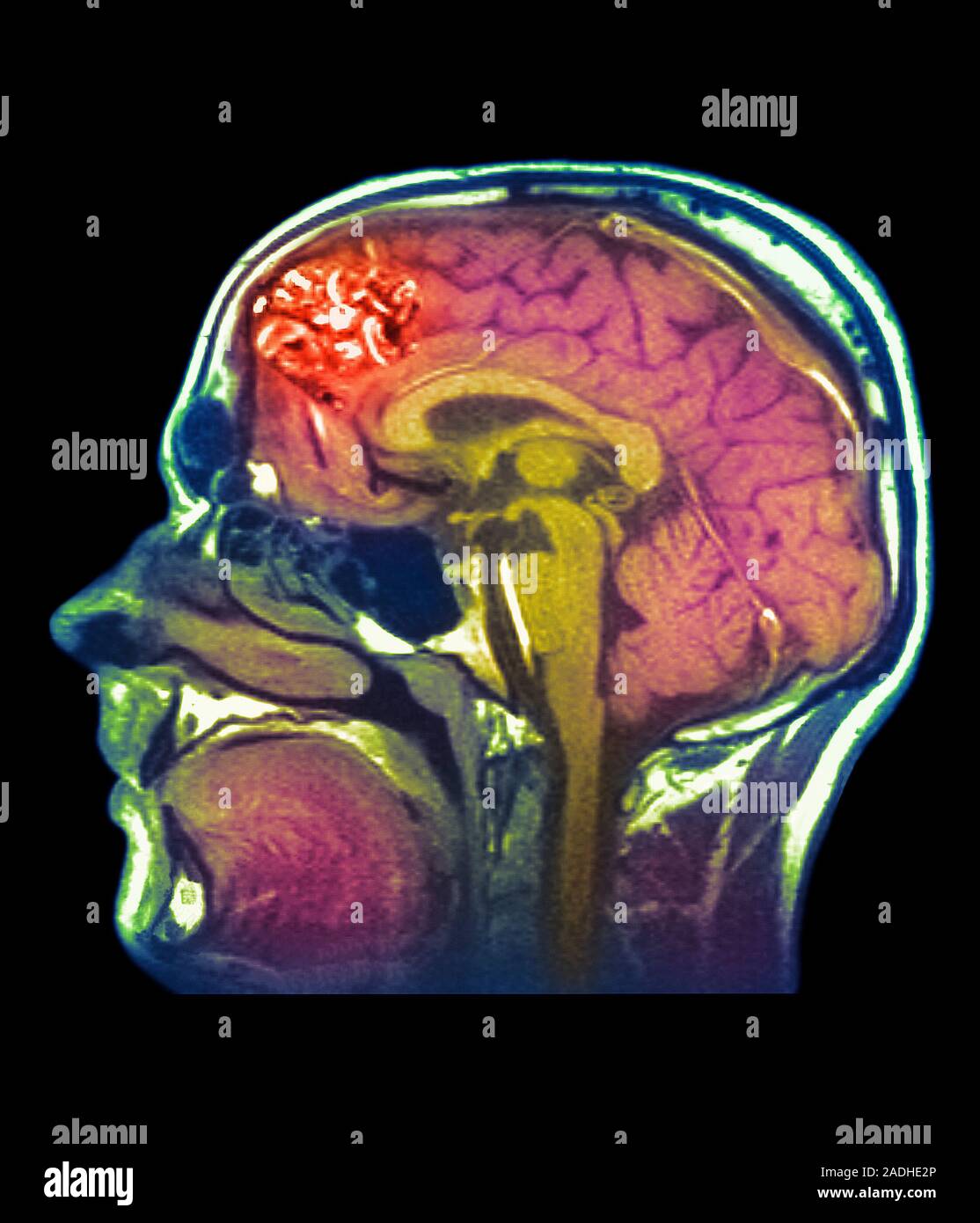 Blood vessel tumour. Coloured magnetic resonance imaging (MRI) head ...