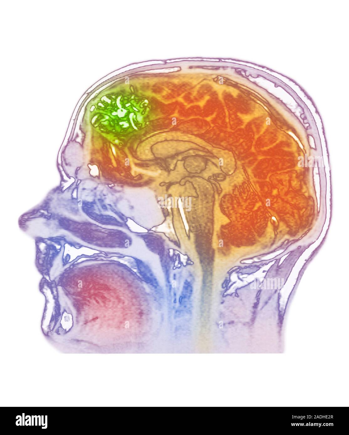Blood vessel tumour. Coloured magnetic resonance imaging (MRI) head ...