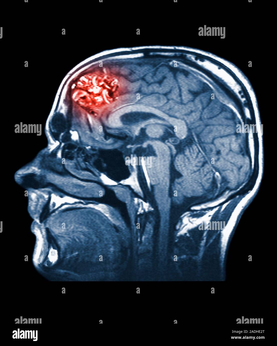 Blood vessel tumour. Coloured magnetic resonance imaging (MRI) head ...