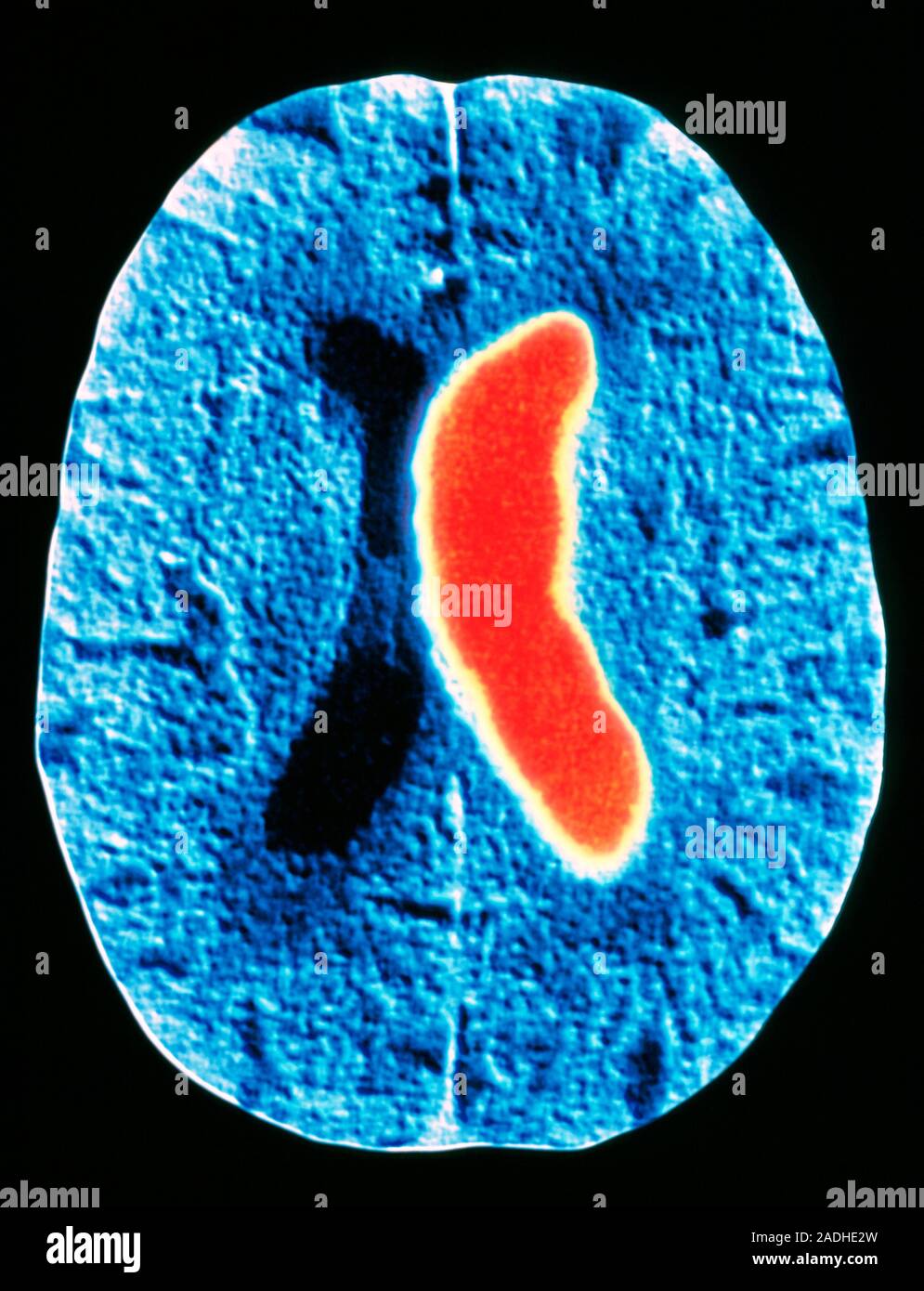 Stroke. Coloured computed tomography (CT) brain scan showing a cerebrovascular accident (CVA ...