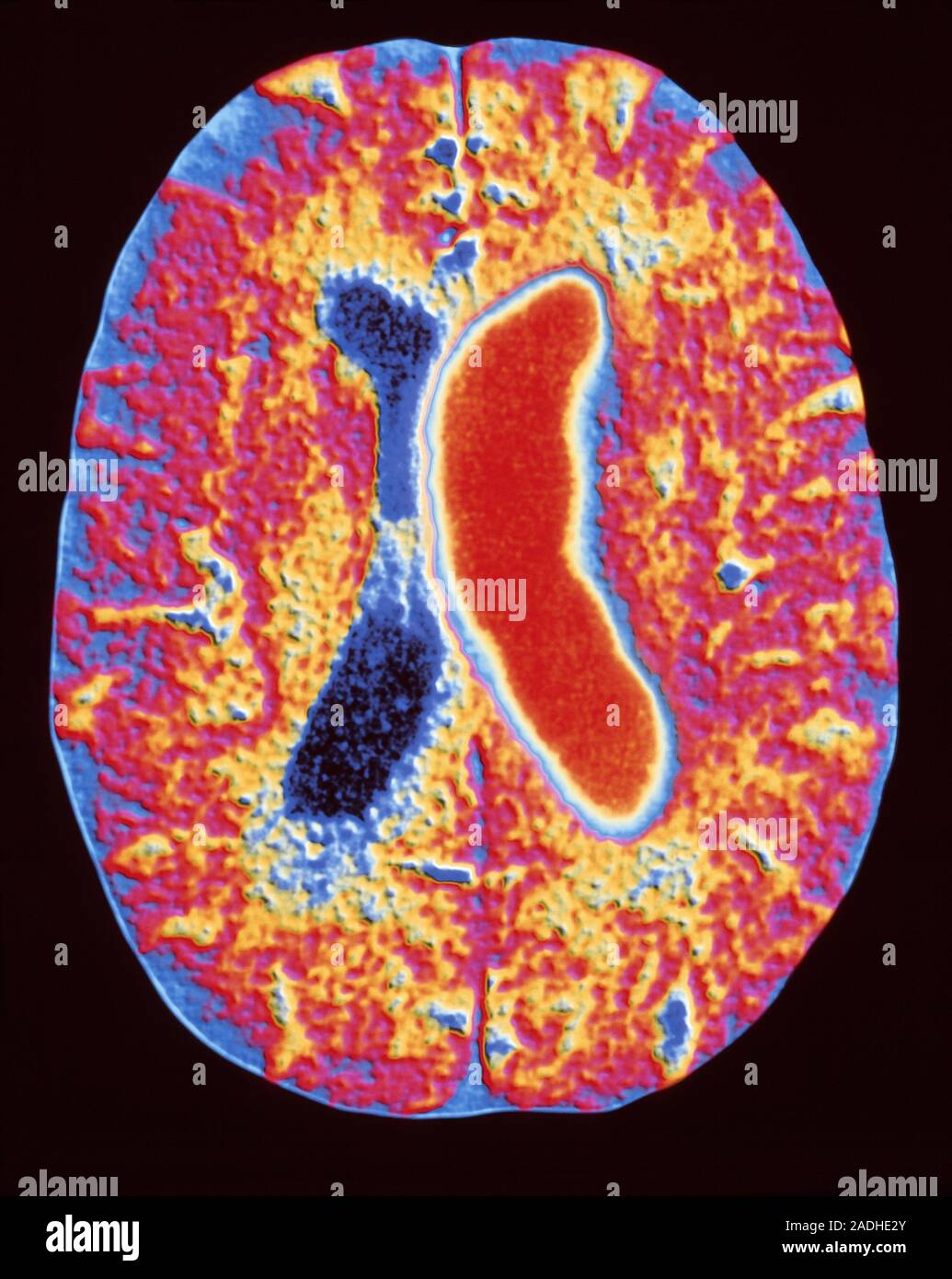 Stroke. Coloured computed tomography (CT) brain scan showing a cerebrovascular accident (CVA ...