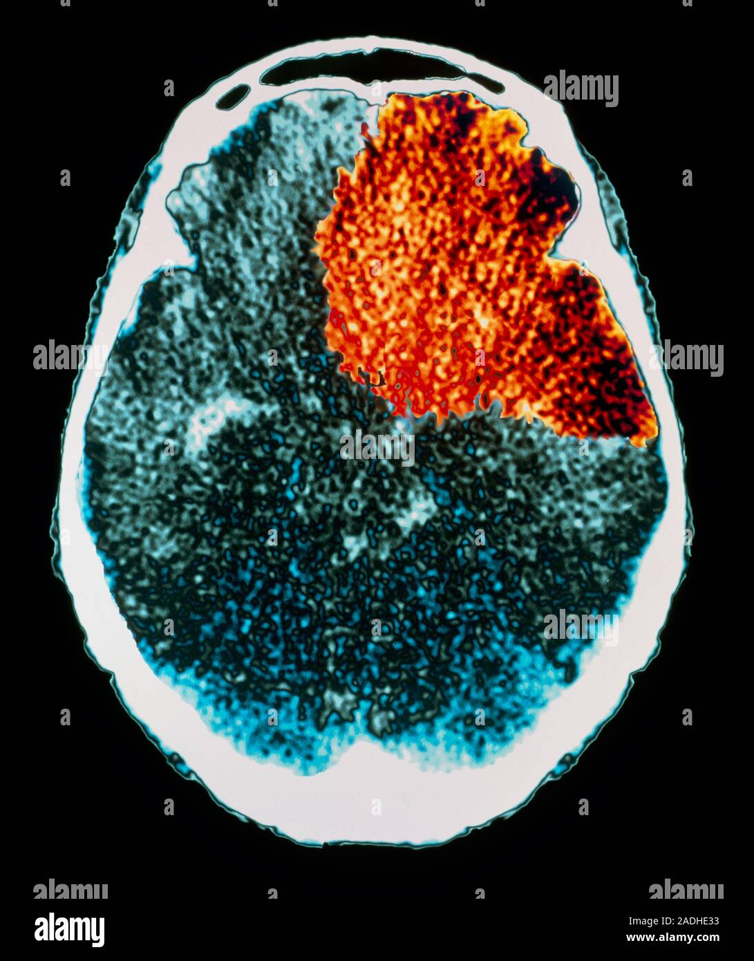 Stroke. Coloured computed tomography (CT) scan of an axial section through a patient's brain ...