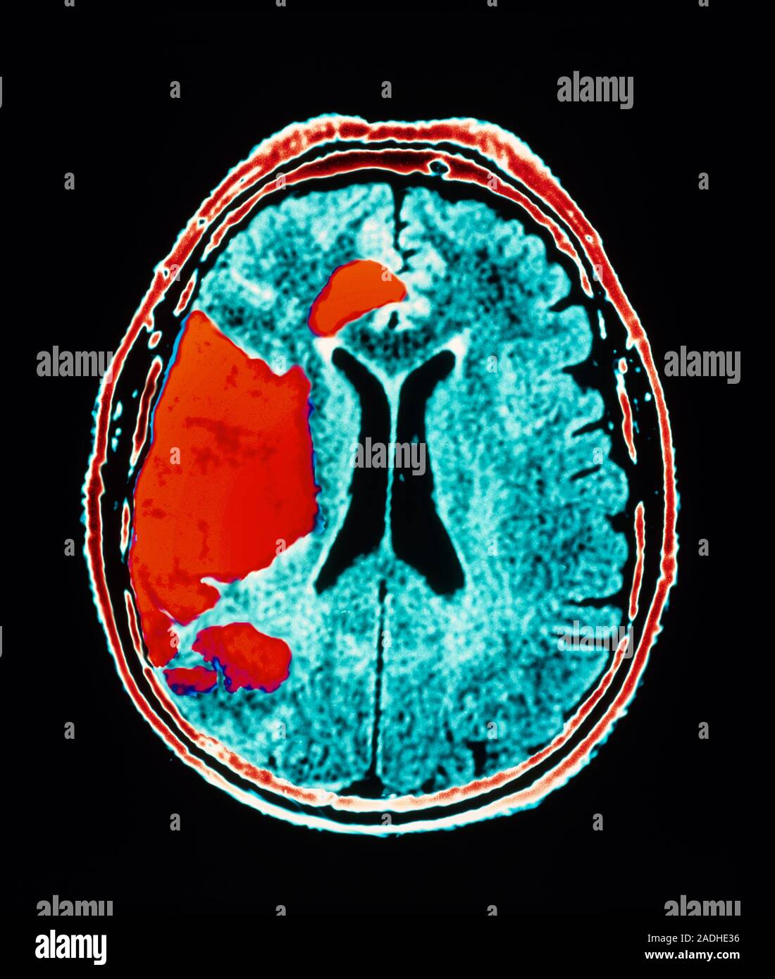 Stroke. Coloured computed tomography (CT) scan of an axial (horizontal ... Stroke. Coloured computed tomography (CT) scan of an axial (horizontal ...