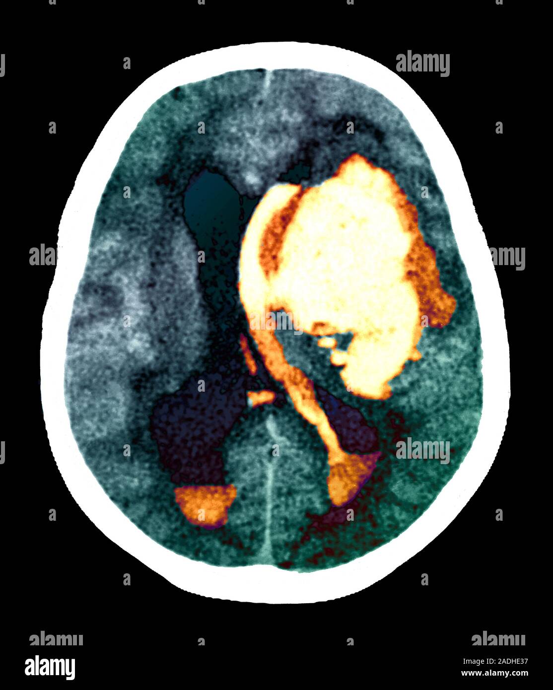 Stroke. Coloured computed tomography (CT) scan of an axial (horizontal) section through a ...