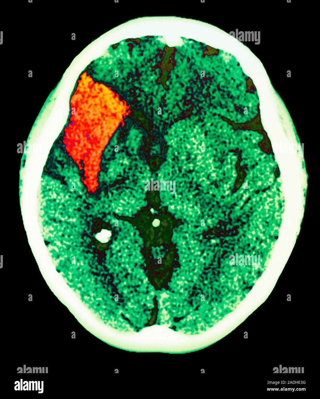 Stroke. Coloured computed tomography (CT) scan of a cerebrovascular ...