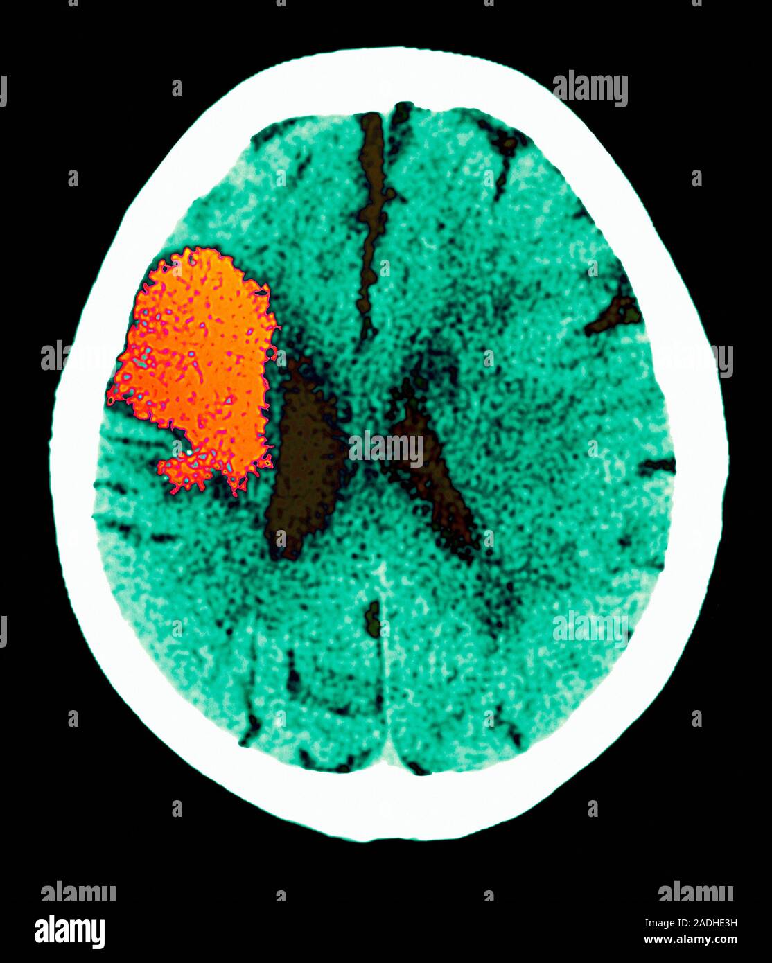 Stroke. Coloured computed tomography (CT) scan of a cerebrovascular ...