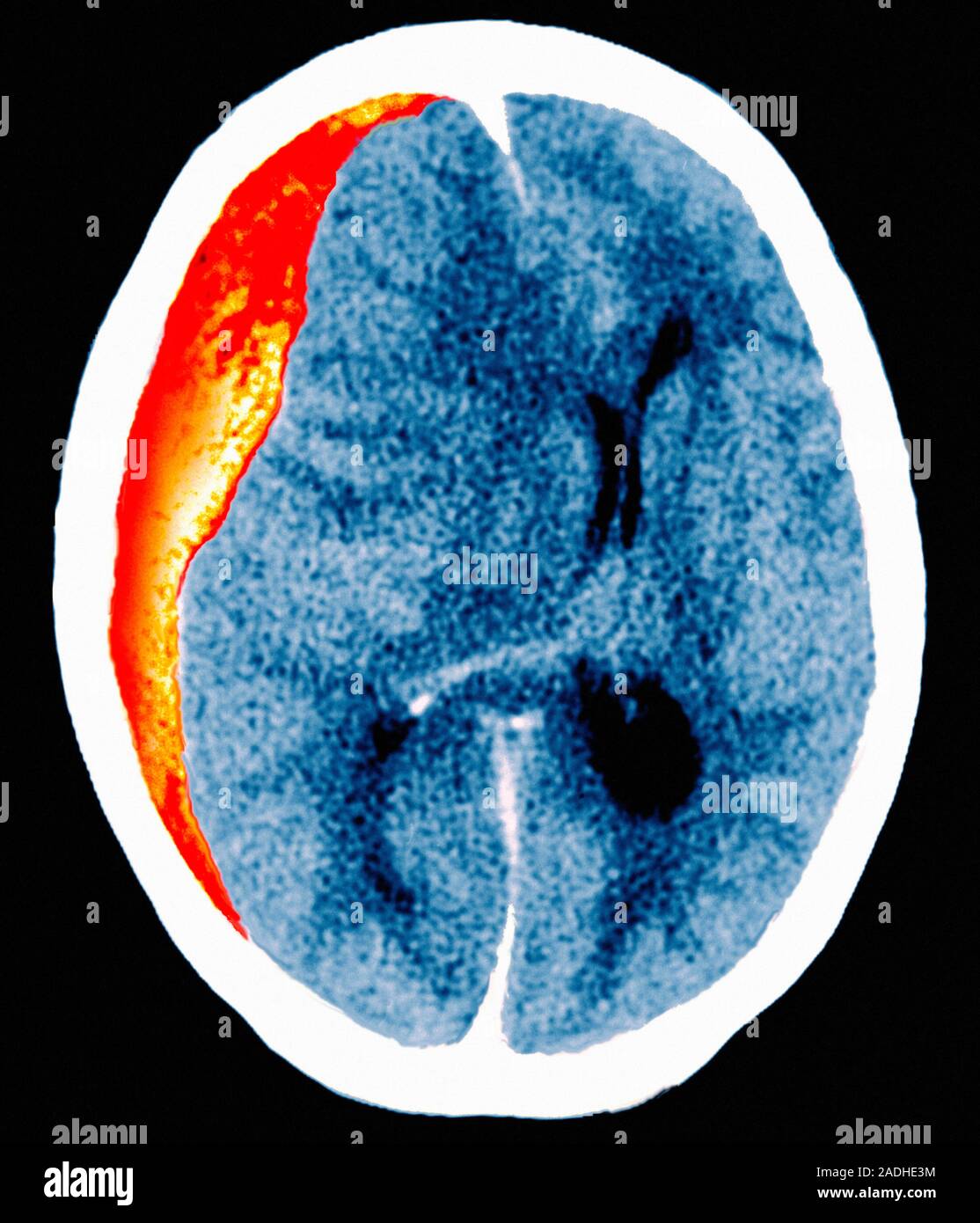 Brain haemorrhage. Coloured axial computed tomography (CT) scan of a section through a head ...