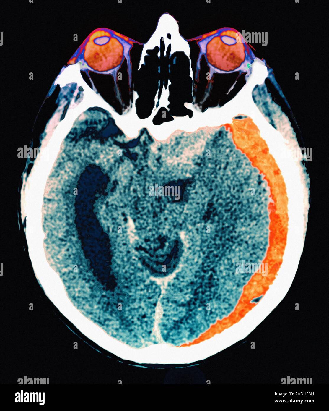 Cerebral haemorrhage. Coloured computed tomography (CT) scan of an axial section through a head ...