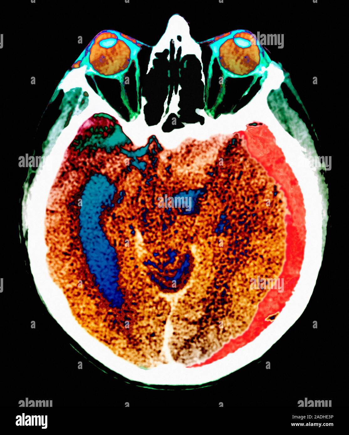 Cerebral haemorrhage. Coloured computed tomography (CT) scan of an axial section through a head ...