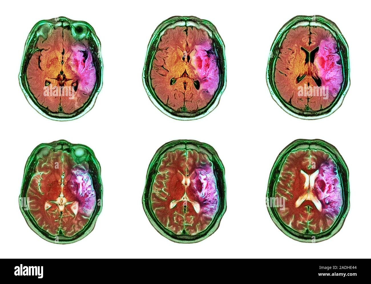 Stroke. Coloured computed tomography (CT) brain scans (axial view ...
