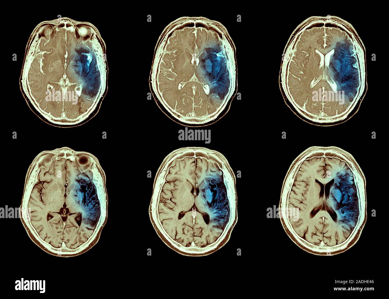 Stroke. Coloured computed tomography (CT) brain scans (axial view ...