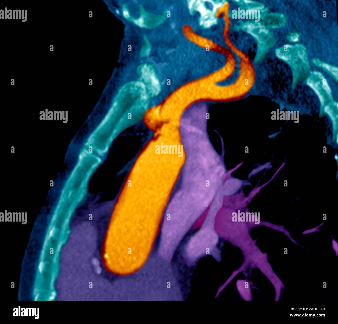Abnormal clotting. Coloured sagittal computed tomography (CT) scan of ...