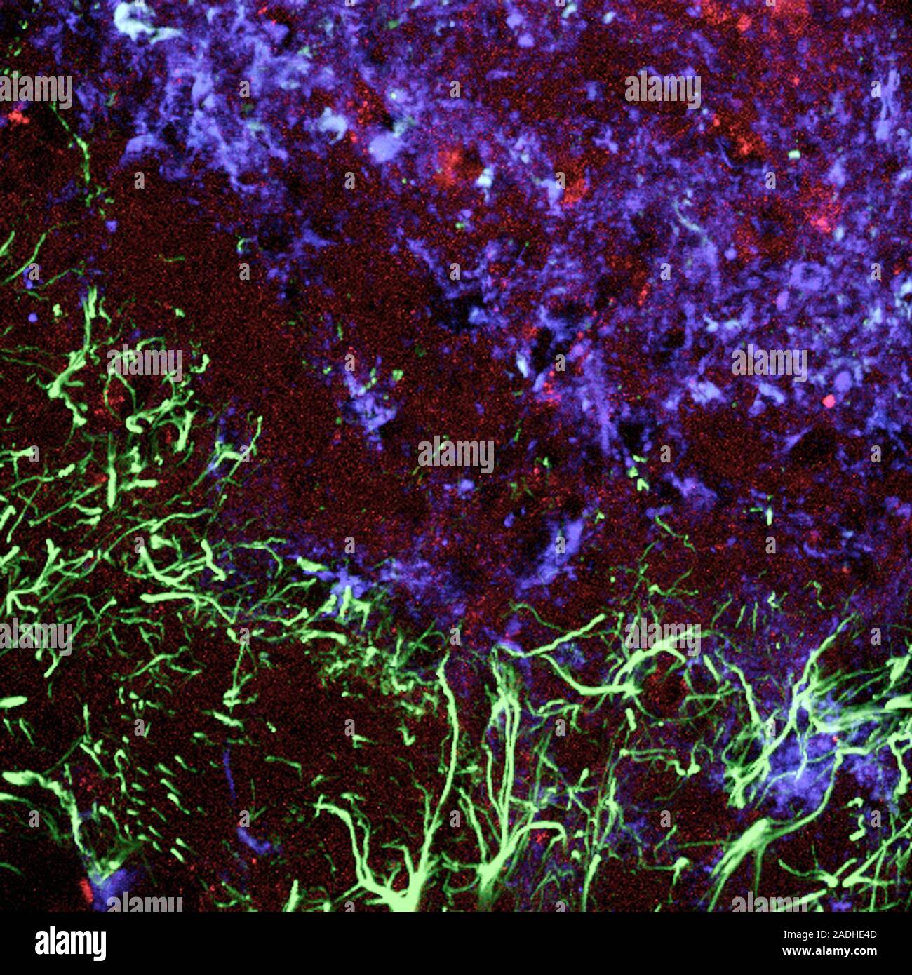 Damaged brain tissue. Confocal light micrograph of a section of damaged ...