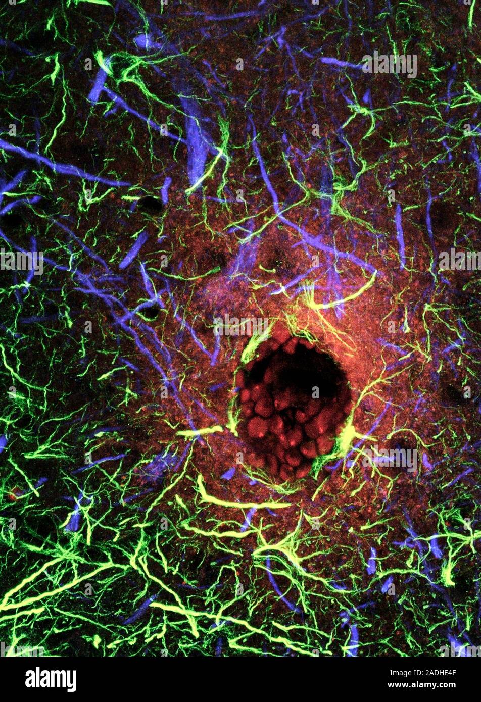 Blood-brain barrier breakdown. Confocal light micrograph of a section ...