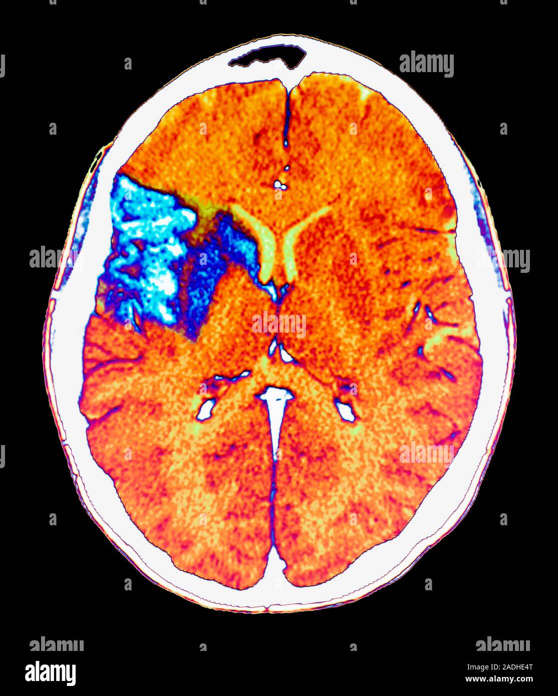 Stroke. Coloured computed tomography (CT) scan of an axial section through the head of a 29-year ...