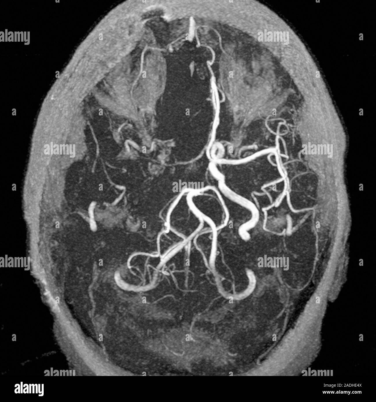 Stroke. Magnetic resonance angiography (MRA) scan of the brain of a 32 year old woman after a ...