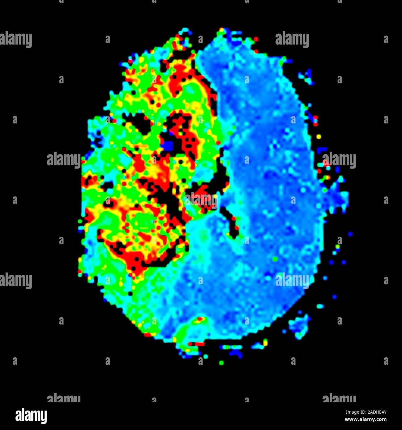 Stroke. Functional magnetic resonance imaging (fMRI) scan of the brain ...