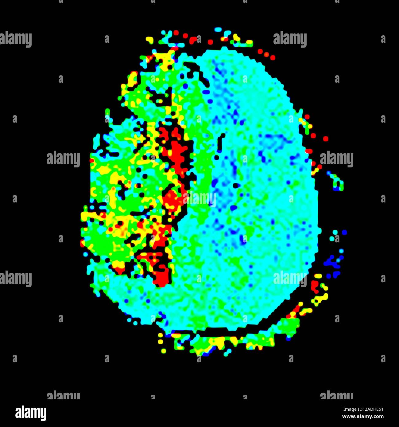 Stroke. Functional magnetic resonance imaging (fMRI) scan of the brain ...