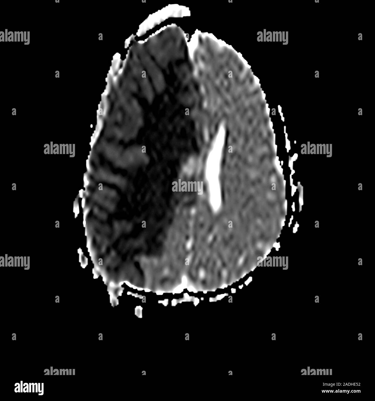 Stroke. Magnetic resonance imaging (MRI) scan of the brain of a 32 year ...