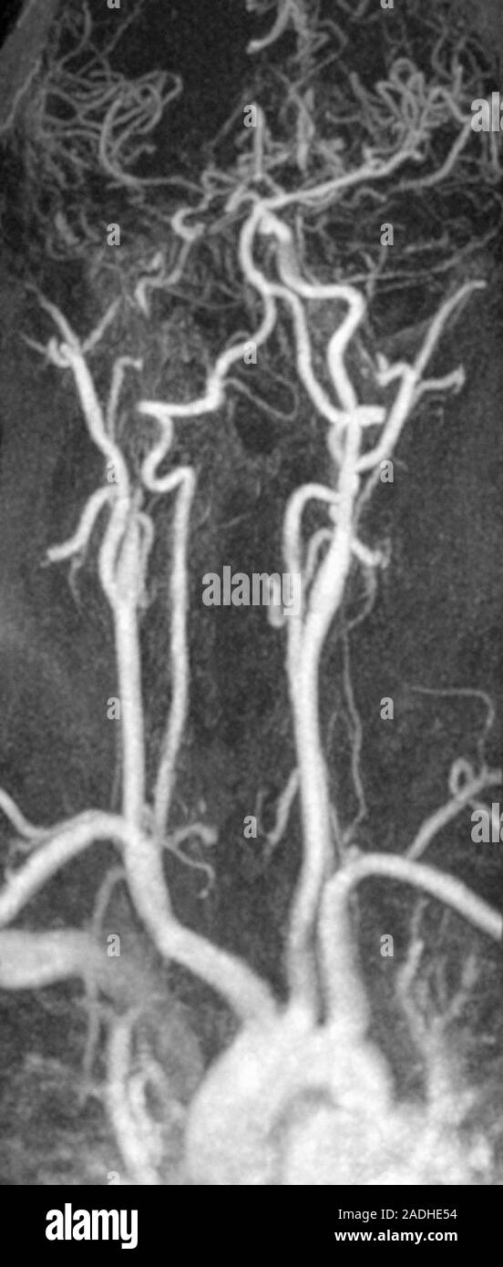 Stroke. Magnetic resonance angiography (MRA) scan of the arteries of ...