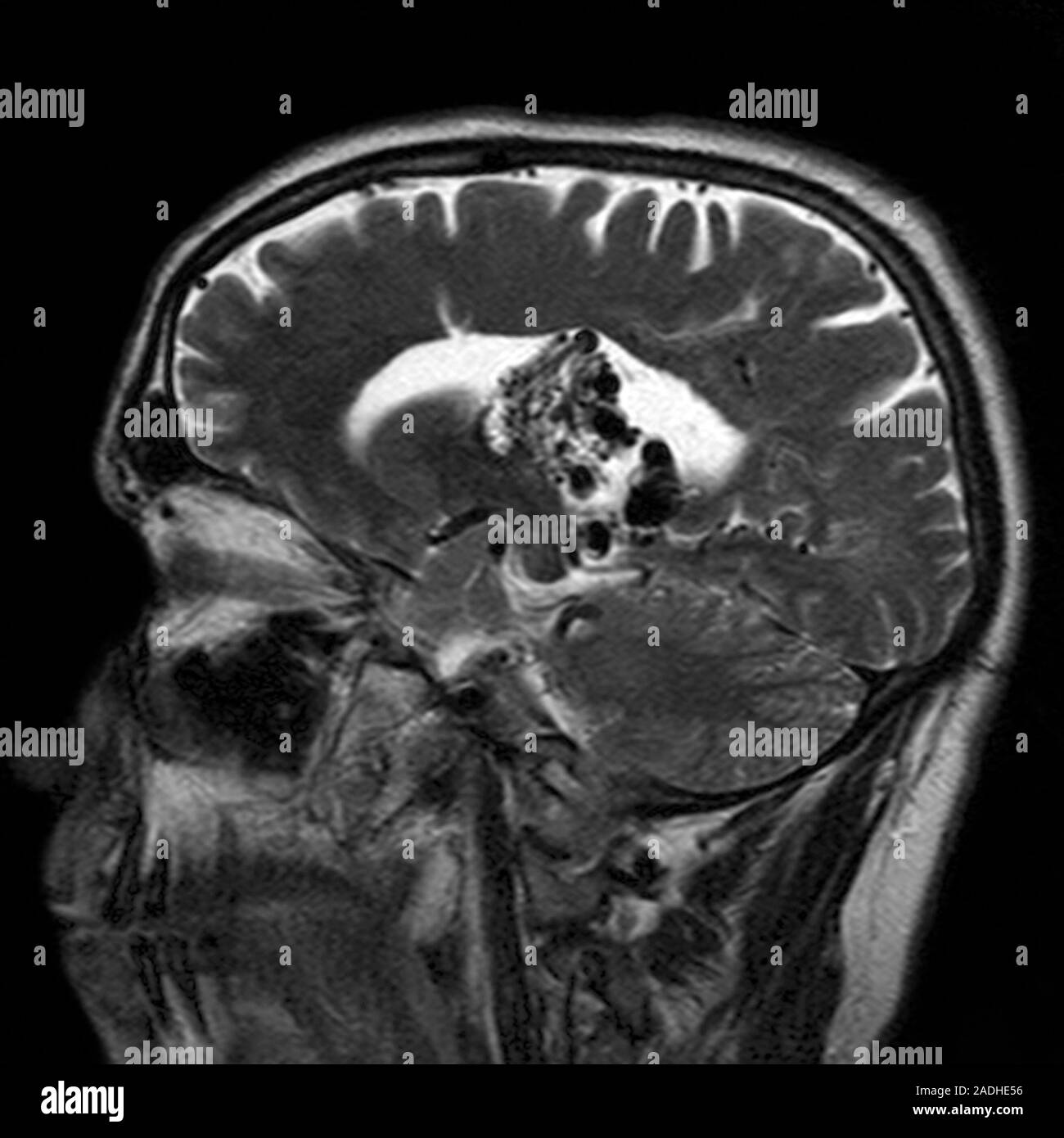 Brain arteriovenous malformation (AVM). Magnetic resonance imaging (MRI ...