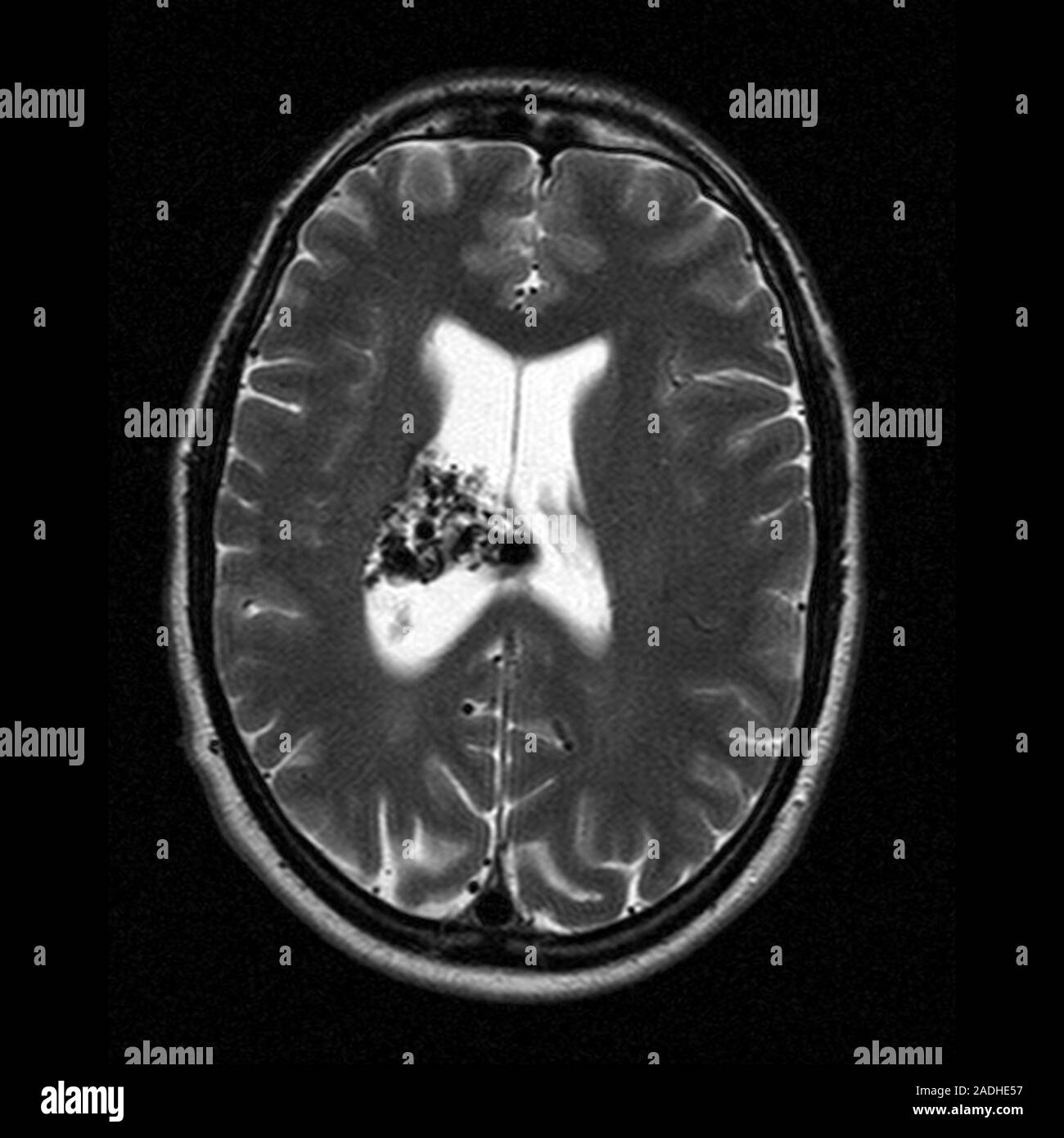 Brain arteriovenous malformation (AVM). Magnetic resonance imaging (MRI ...