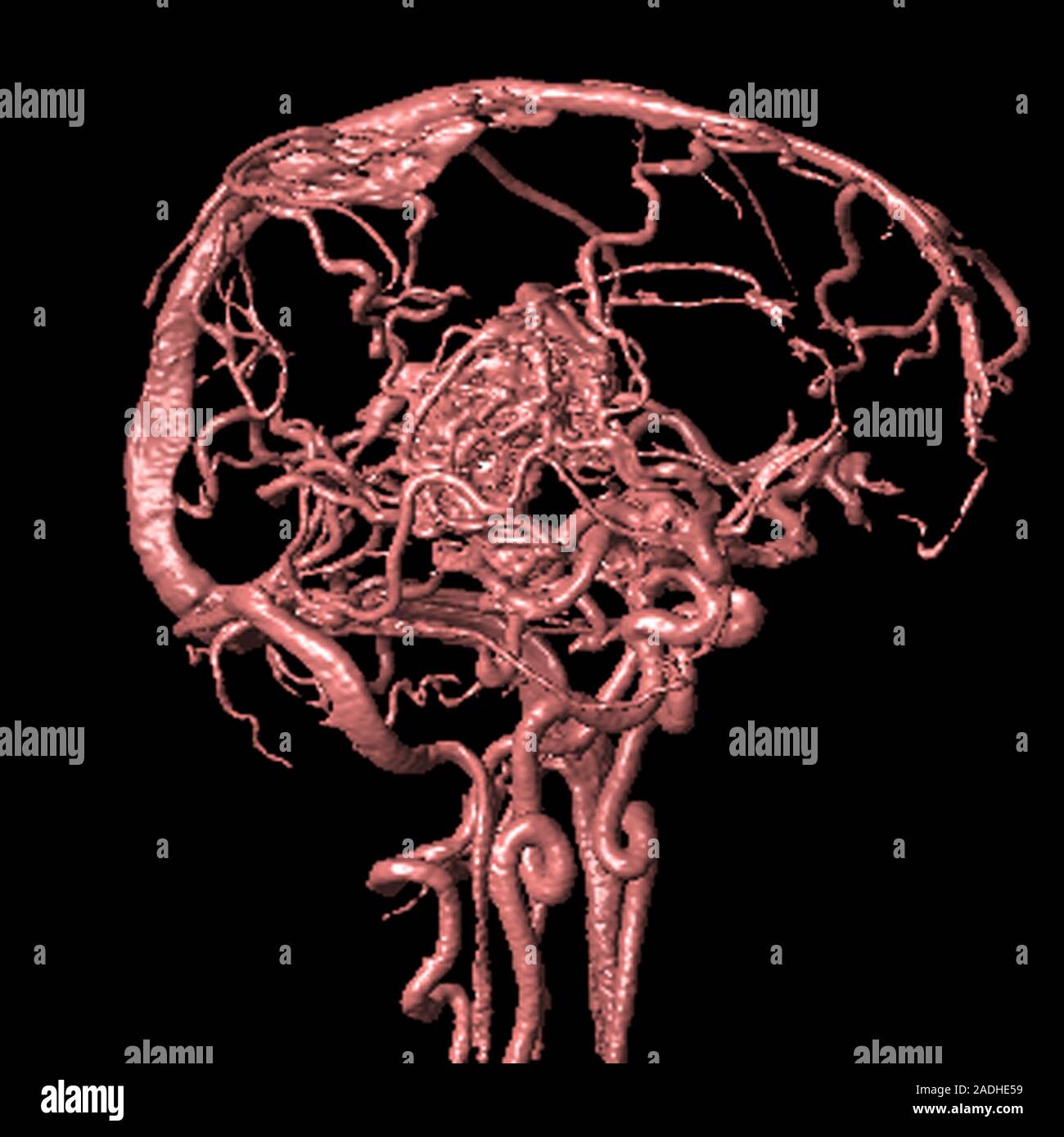 Brain arteriovenous malformation. Image 2 of 6. Coloured magnetic ...