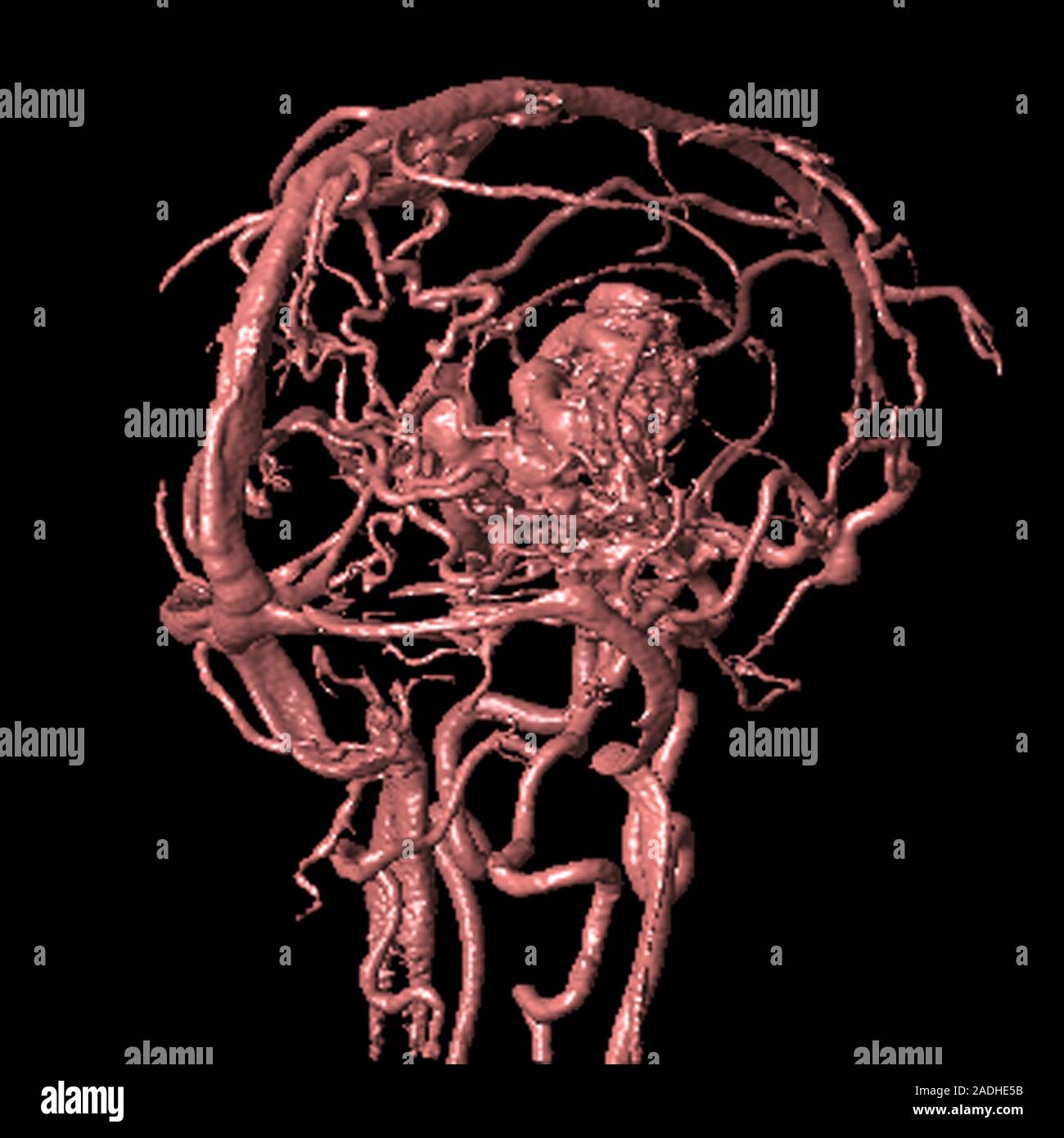 Brain arteriovenous malformation. Image 3 of 6. Coloured magnetic ...