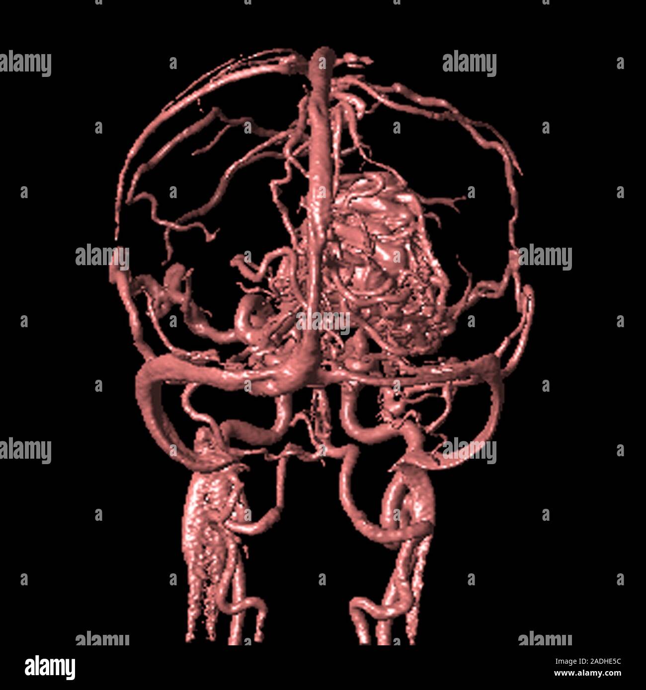 Brain arteriovenous malformation. Image 4 of 6. Coloured magnetic ...