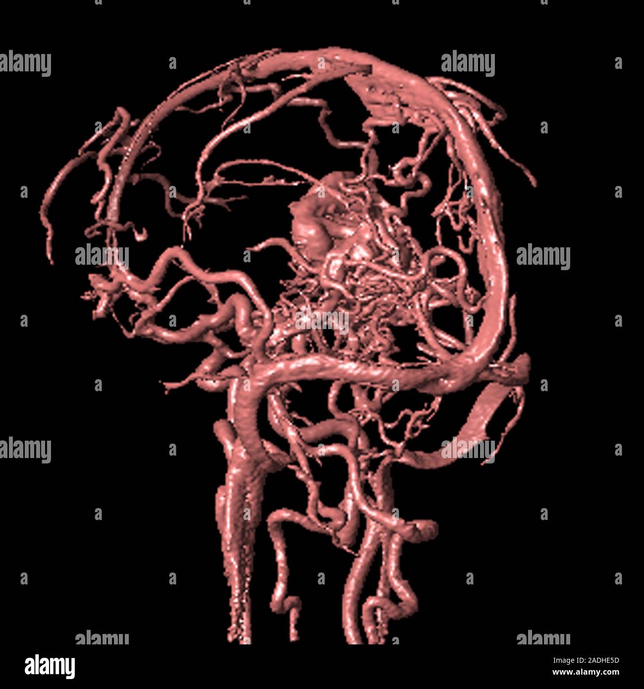 Brain arteriovenous malformation. Image 5 of 6. Coloured magnetic ...