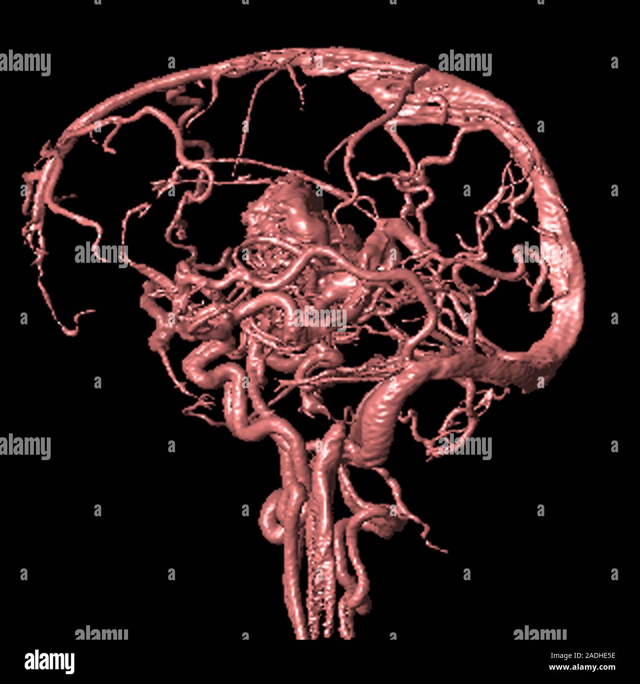 Brain arteriovenous malformation. Image 6 of 6. Coloured magnetic ...