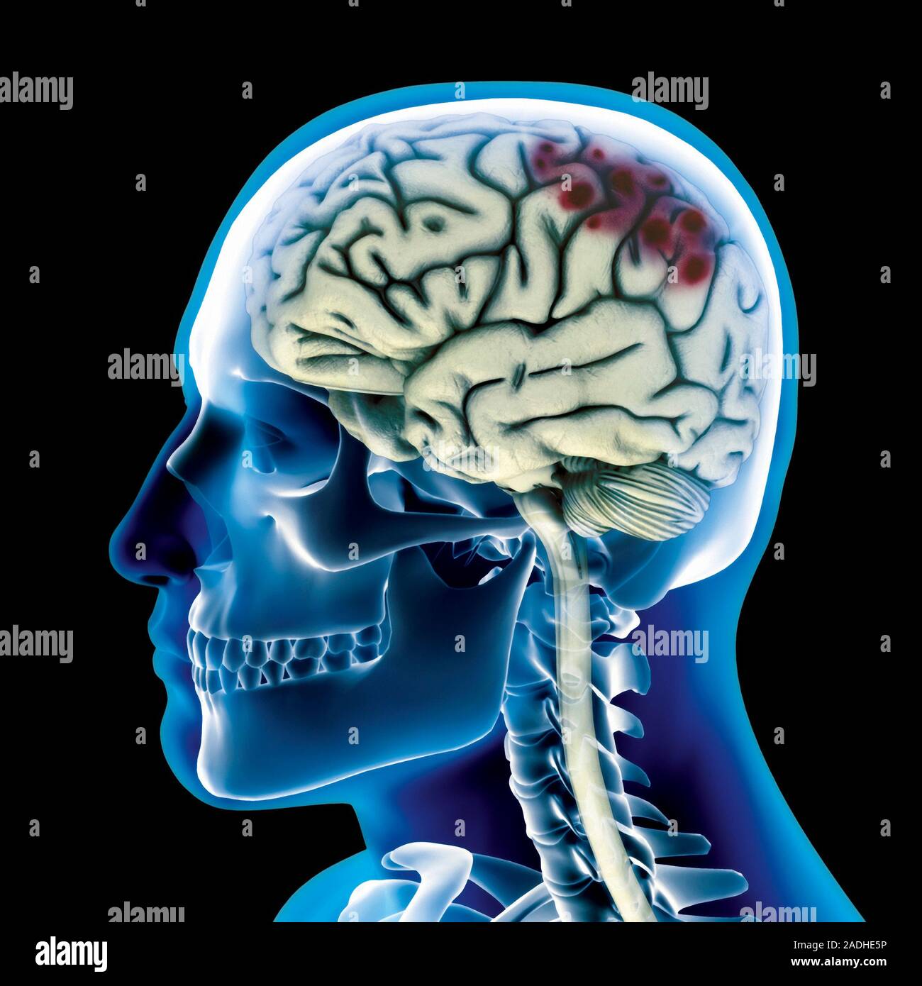 Head injury. Computer artwork of the head of a person with a subdural ...