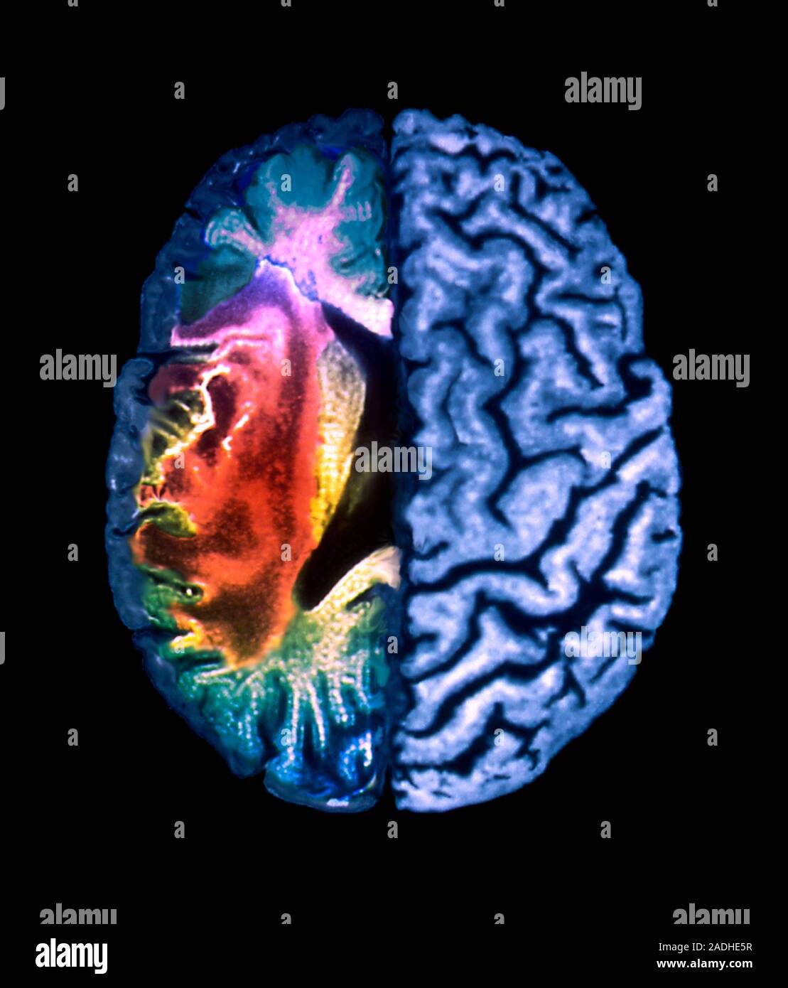 Stroke. Coloured magnetic resonance imaging (MRI) scan of the brain of ...