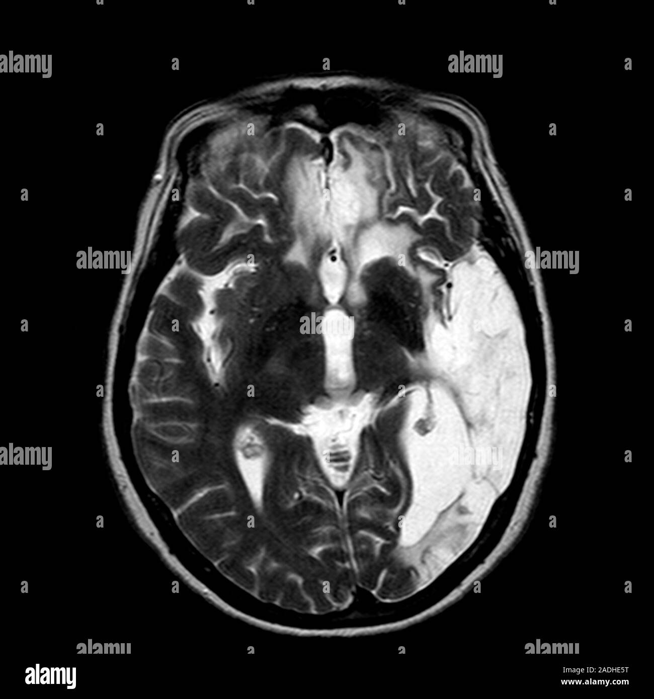 Haemorrhagic stroke damage. Magnetic resonance imaging (MRI) scan of ...