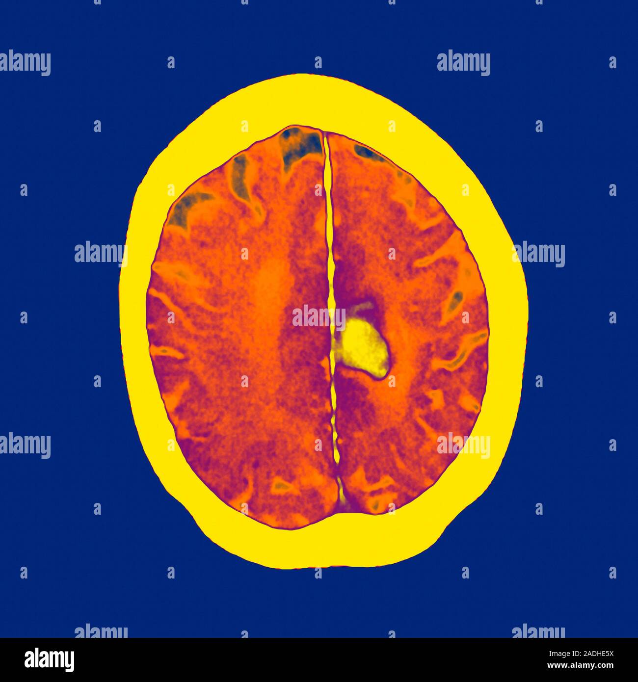 Brain haemorrhage. Coloured computed tomography (CT) scan of a section through the brain of a ...
