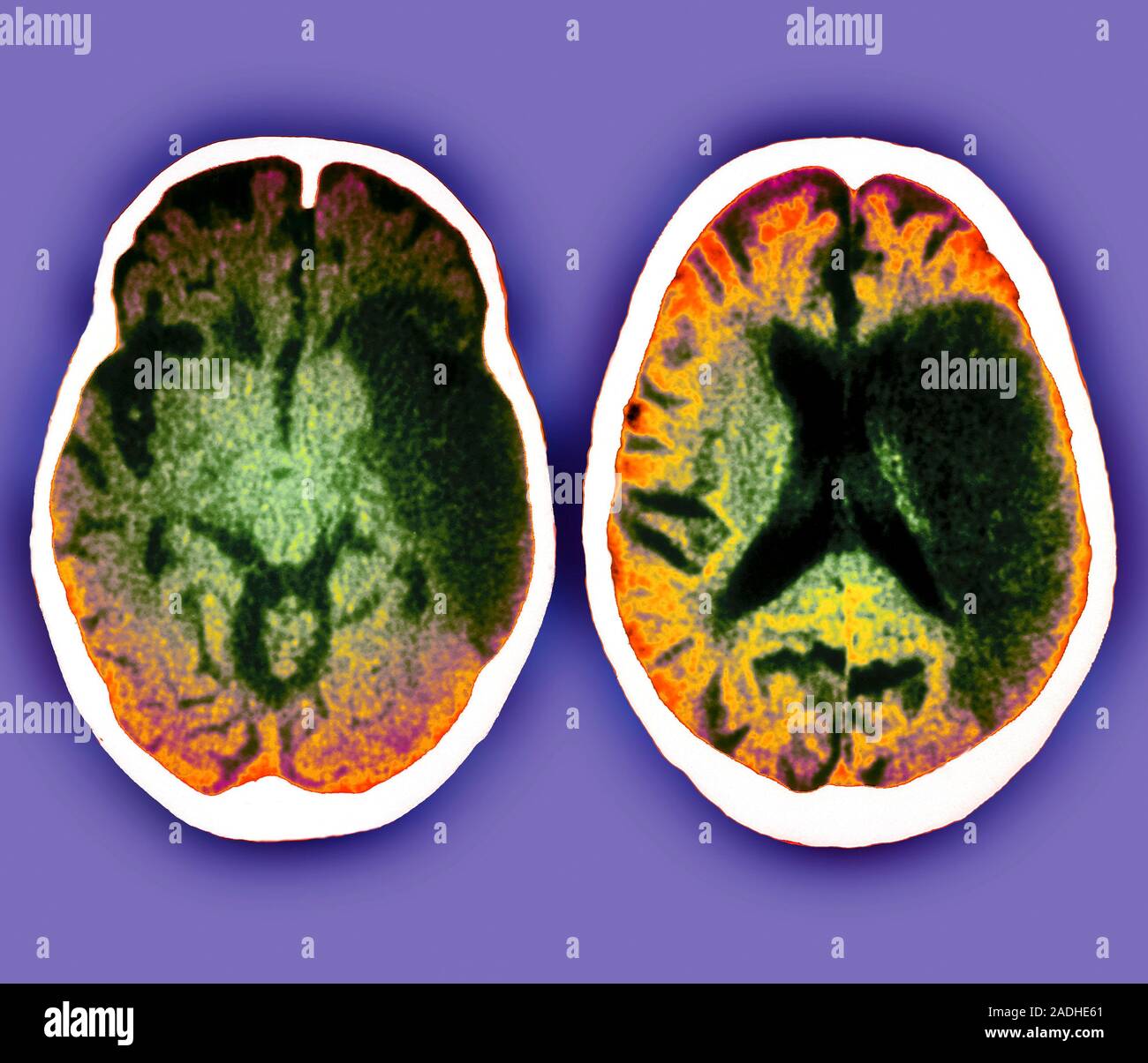 Stroke. Coloured computed tomography (CT) scans of axial sections through the head of a 62-year ...