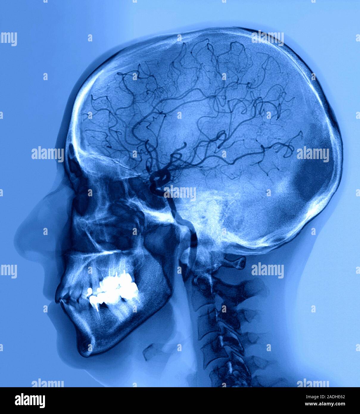 Stroke treatment. Coloured angiogram of the brain of a 48 year old ...