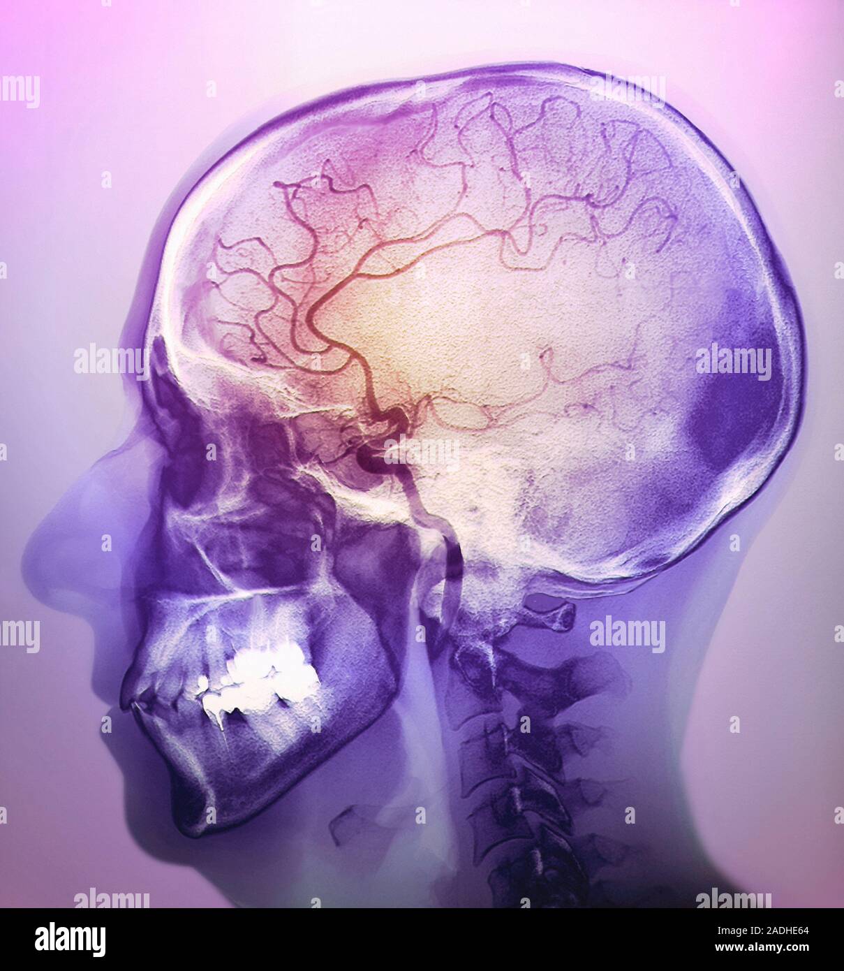 Stroke. Coloured angiogram of the brain of a 48 year old patient after ...