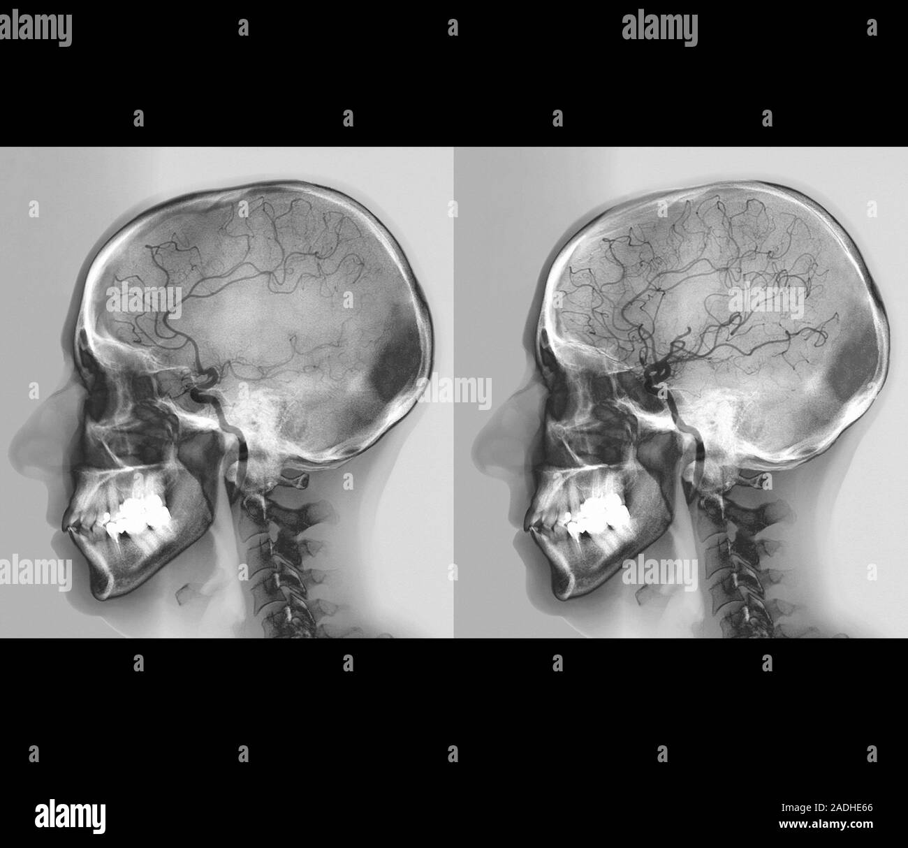 Stroke treatment. Angiogram of the brain of a 48 year old patient ...