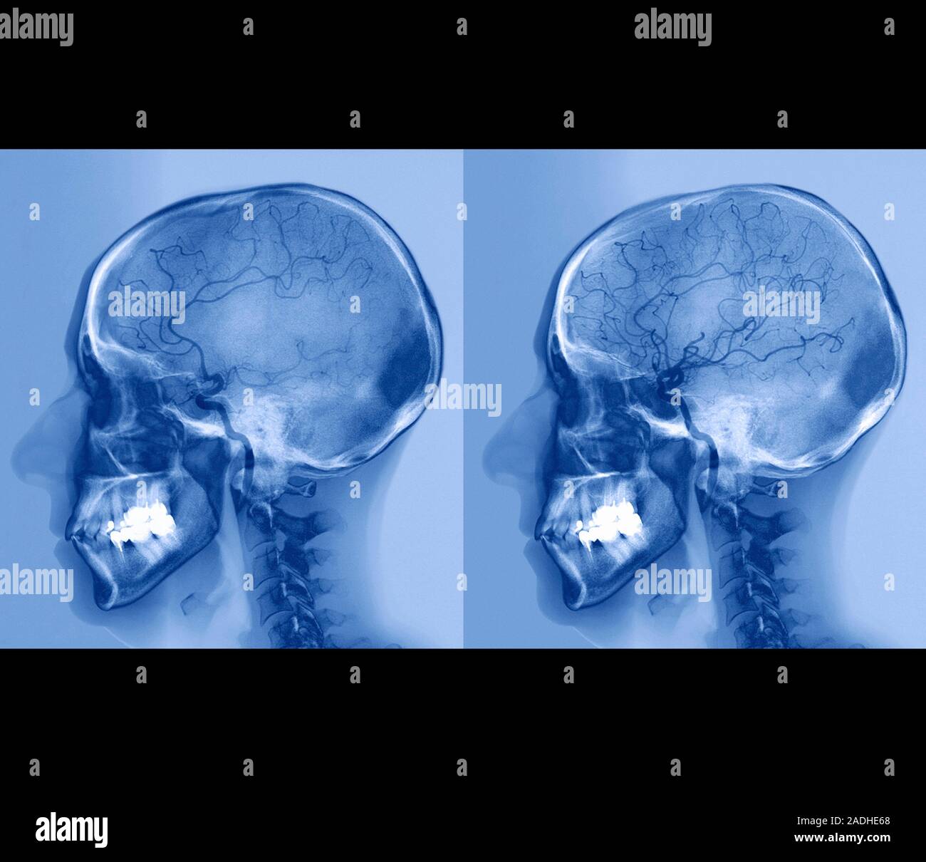 Stroke treatment. Coloured angiogram of the brain of a 48 year old ...