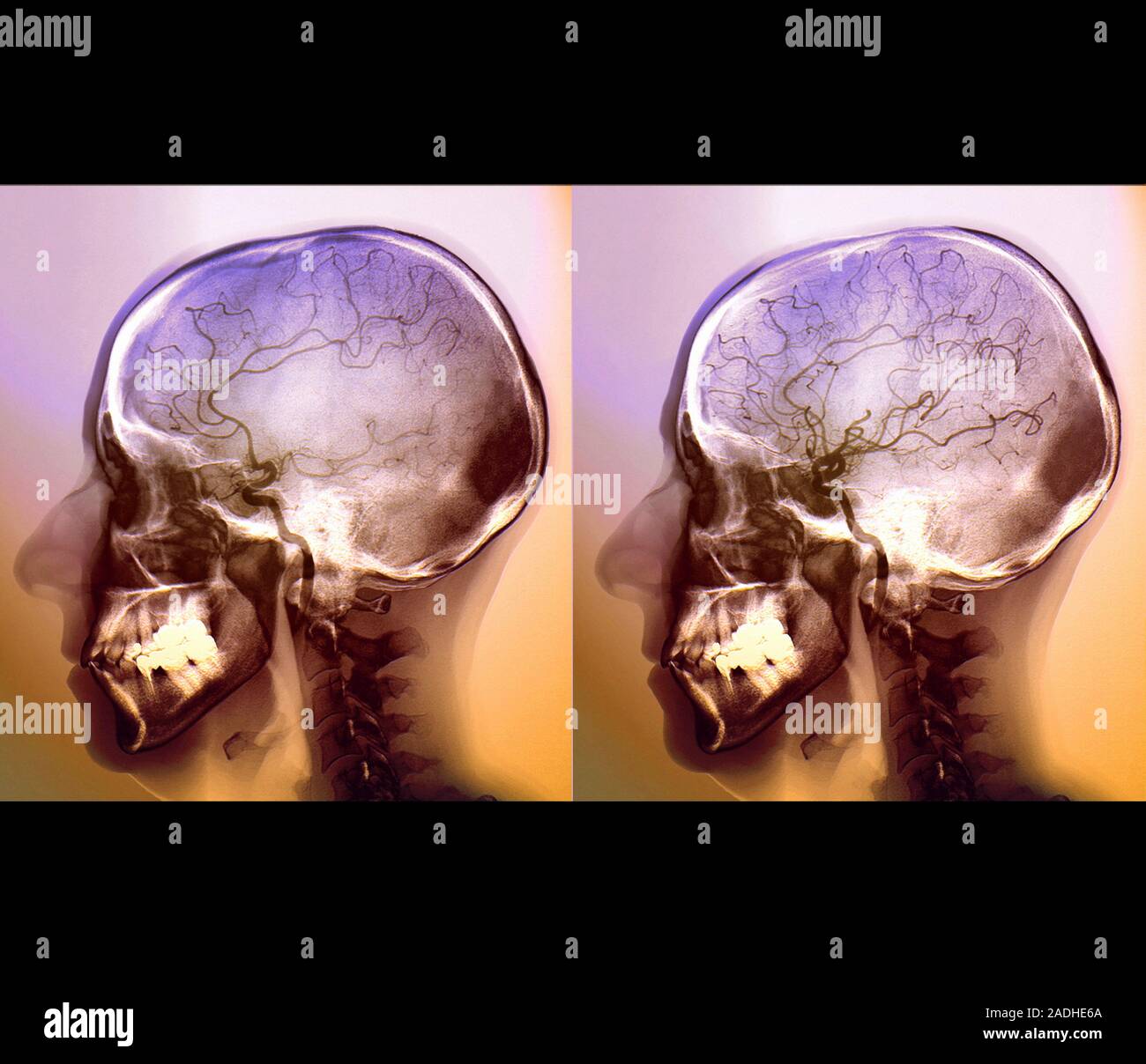 Stroke treatment. Coloured angiogram of the brain of a 48 year old ...