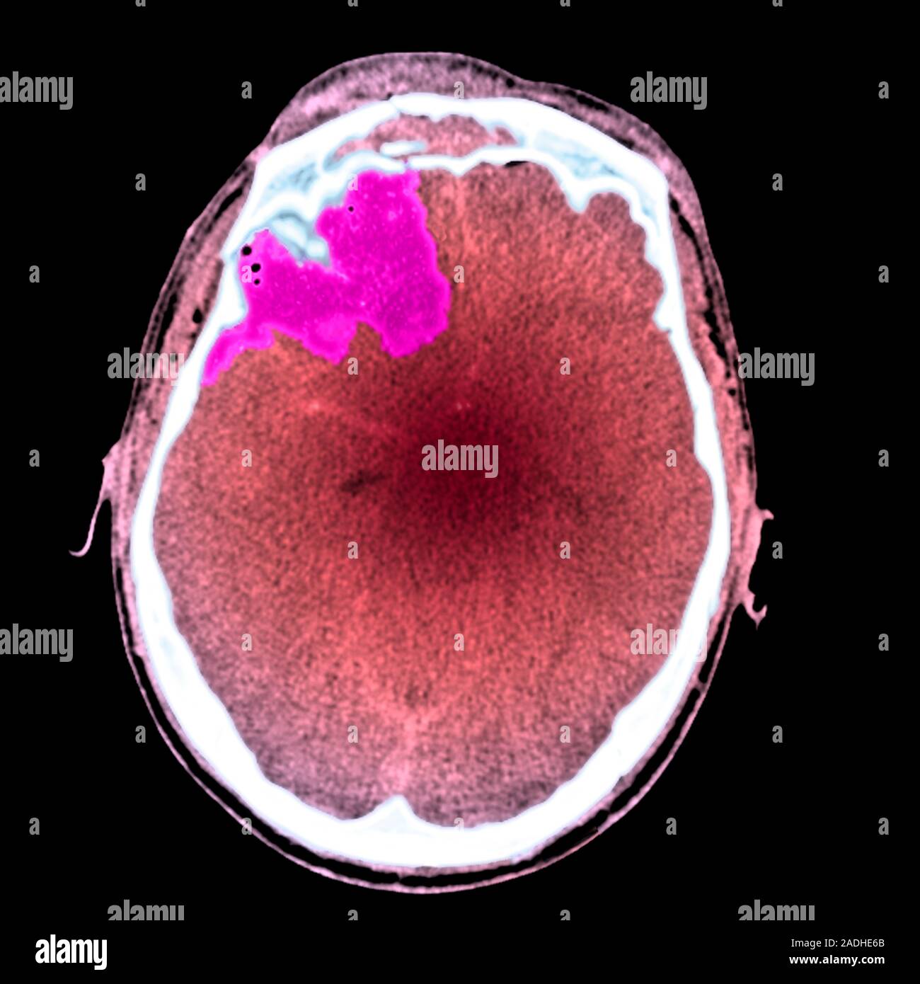 Brain haemorrhage, coloured computed tomography (CT) scan. The front of the brain is at top, and ...