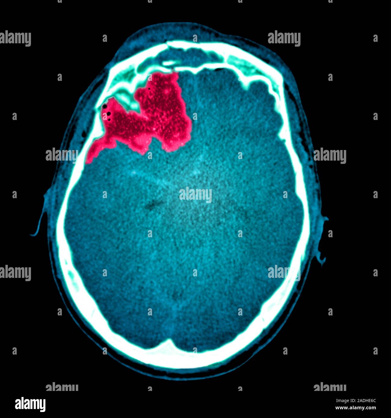 Brain haemorrhage, coloured computed tomography (CT) scan. The front of the brain is at top, and ...