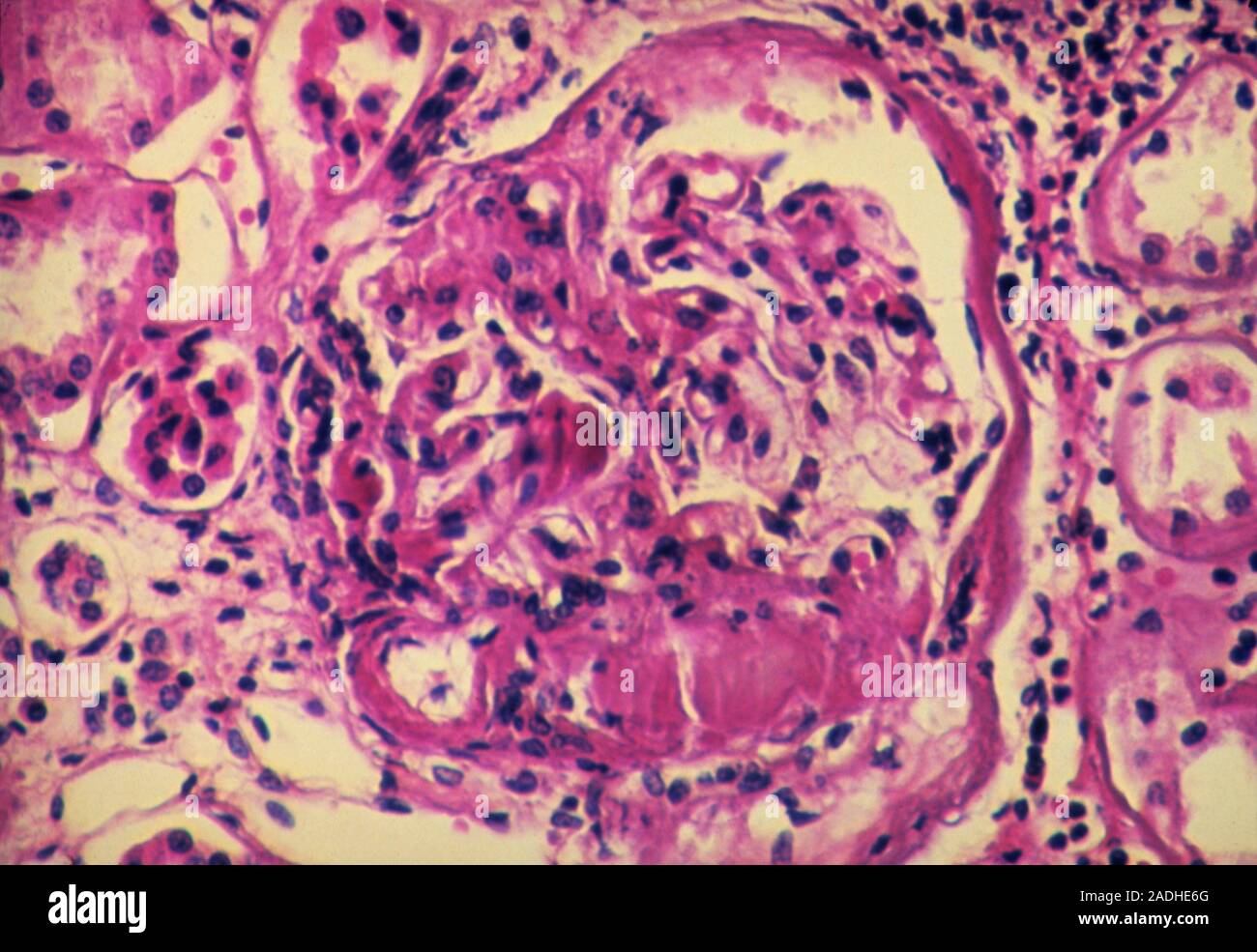 Light micrograph showing nodular & fibrous exudates in the glomerulus ...